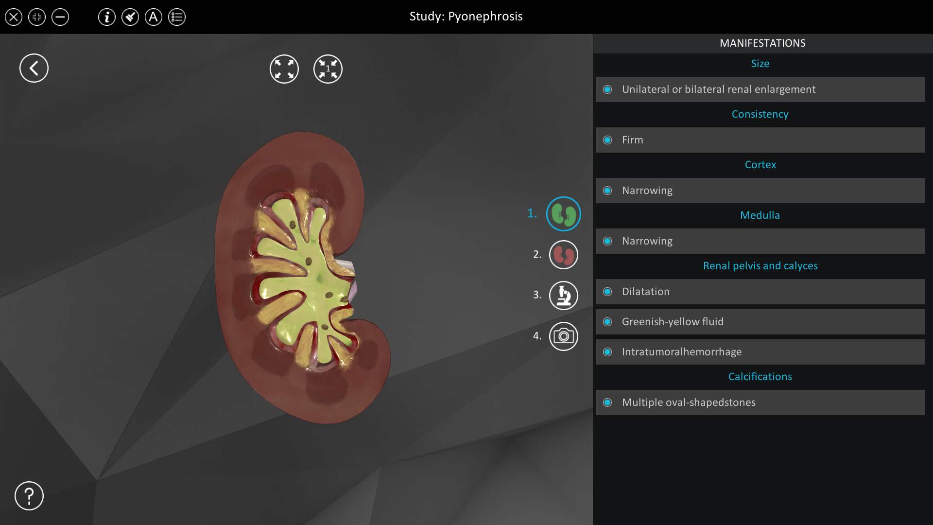 Pyonephrosis | ROQED